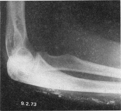 Lateral X Ray Ofleft Elbow To Show Extensive Soft Tisue Calcification