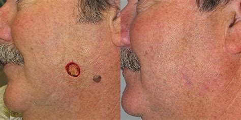Cheek Reconstruction Gallery Skin Cancer And Reconstructive Surgery