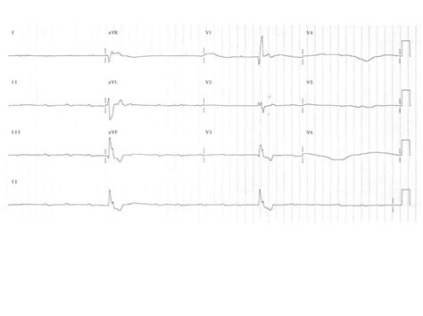 Ecg Lecture Sinus Arrest Sinoatrial Exit Block Av Block And Escape