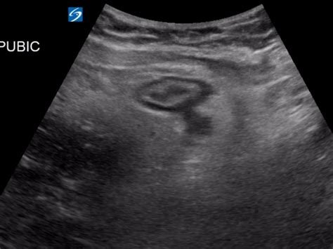 Diverticulitis Critical Care Sonography