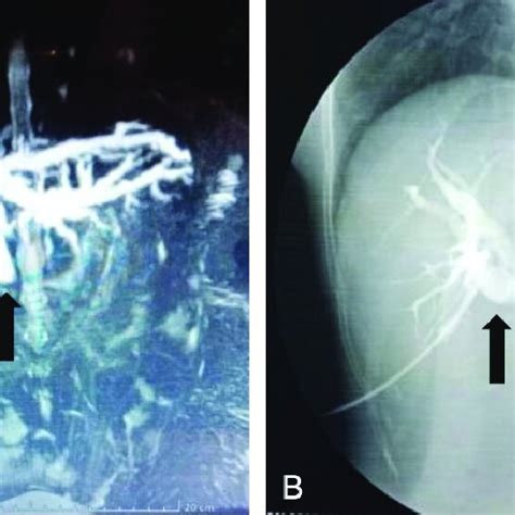 A Magnetic Resonance Cholangiopancreatography Imaging Without Download Scientific Diagram