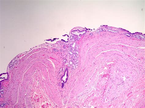 Chronic Cholecystitis Gross