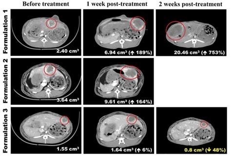 CT Scan Images Present The Tumors Before Treatment And At Different Download Scientific Diagram