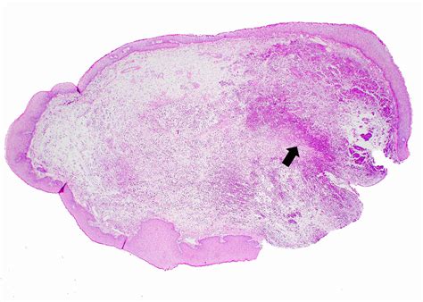 Abscess Histology At Willa Melvin Blog