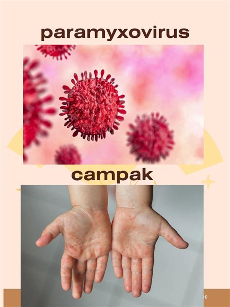 Paramyxovirus Penyebab Demam Campak