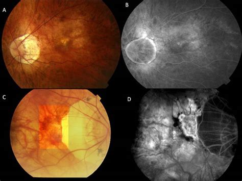 Retinacare Guide To Myopic Macular Disease