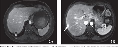 Figure 2 From Hepatic Cyst Versus Hemangioma Useful T2 Flair Image For
