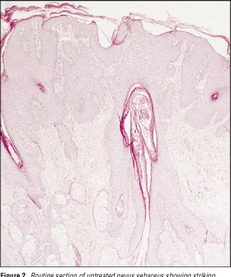Figure 2 From Photodynamic Therapy For Nevus Sebaceus With Topical Cid