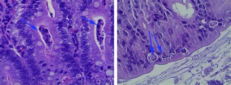 A Duodenum Aza1 Cryptabscesses × 40 And B Duodenum Aza6