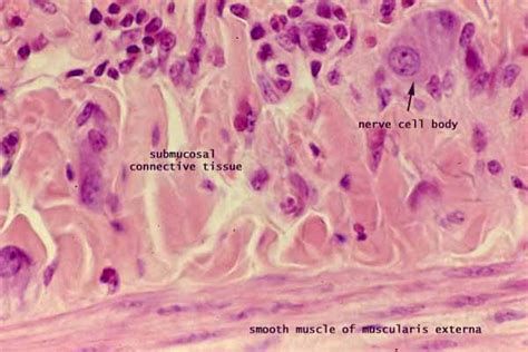 Submucosal Plexus In The Small Intestine Infiltration