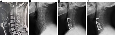 Female 50 Year Old Underwent One Level Anterior Cervical Discectomy