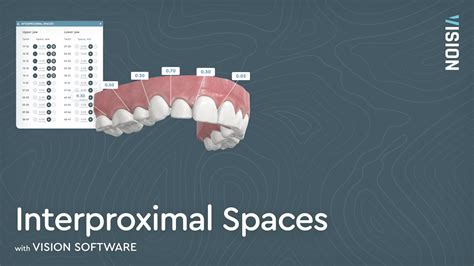 Interproximal Spaces Youtube