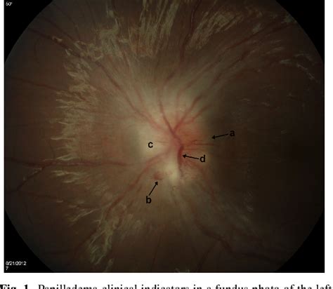 Pdf Automating Detection Of Papilledema In Pediatric Fundus Images With Explainable Machine