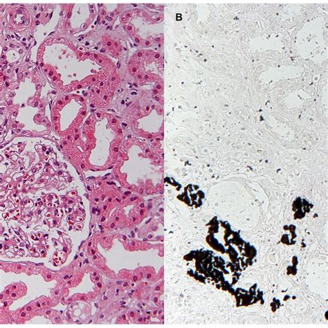 Renal Biopsy Findings In Acute Phosphate Nephropathy A Abundant Download Scientific Diagram