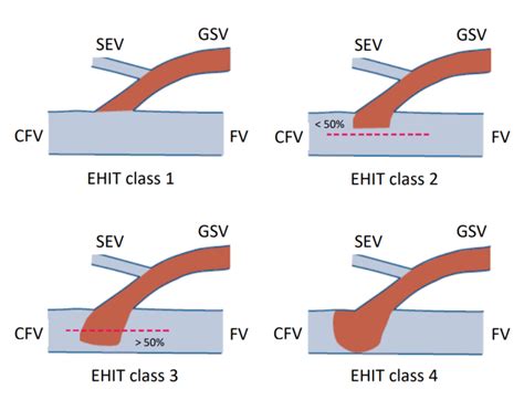 Ehit Endovenous Heat Induced Thrombus 의 2021년 Version[논문 톺아읽기 1] 네이버 블로그