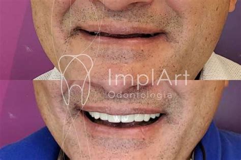 Bruxismo antes depois coroas ceramicas 2 Clínica Odontológica de