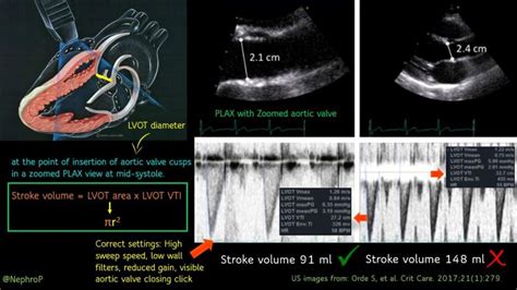 Infographics Nephropocus