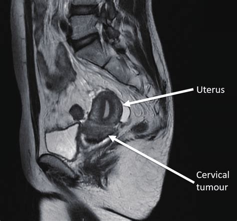 Magnetic Resonance Imaging Of The Pelvis T2 Weighted Sagittal View Download Scientific Diagram