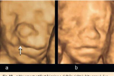 Cleft Lip 3d Ultrasound