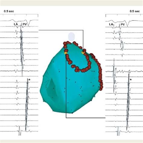 Mapping And Ablation Of Two Remaining Conduction Gaps After Anatomical Download Scientific