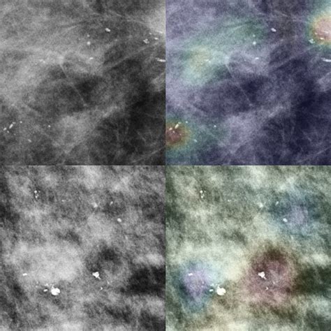Left Column Depicts The Original Malignant Microcalcification Images Download Scientific