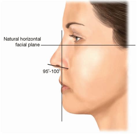 Techniques For Controlling Tip Rotation In Open Rhinoplasty Plastic