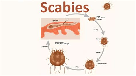 Can Dermatoscope Detect Scabies Iboolo