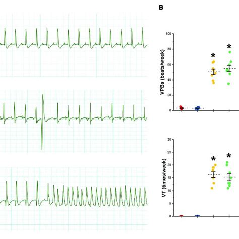 A Typical Examples Of Ecg Graphs Of Normal Beats Ventricular