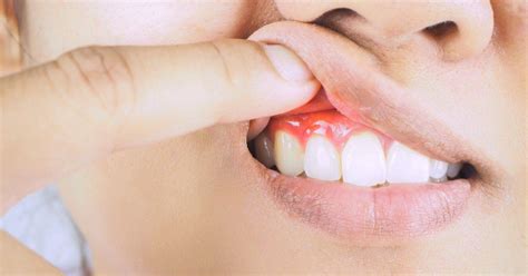 Gum Disease Stages What Are The Symptoms Of Gum Disease