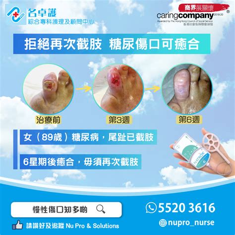 糖尿腳 名卓護專科護士中心