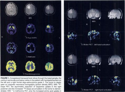Figure2 Transaxial And Reconstructed Frontal And Sagittal Mri Alces Download Scientific