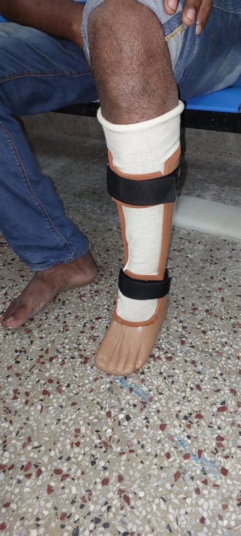Partial Foot Prosthesis Easy Life For Bangladesh