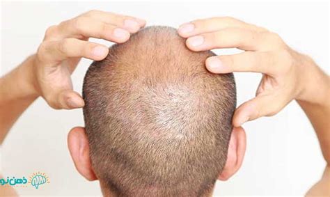 تعبیر خواب کچل شدن معنی کچل شدن در خواب از نظر معبران مختلف ذهن نو