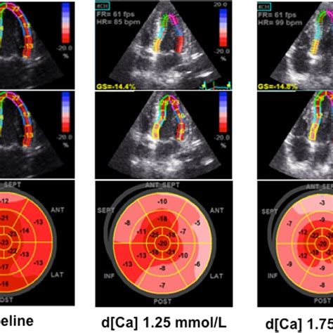 Global Longitudinal Strain Gls At Baseline And At The Peak Of Hd With
