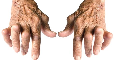 Over Time Rheumatoid Arthritis Can Lead To Deformities