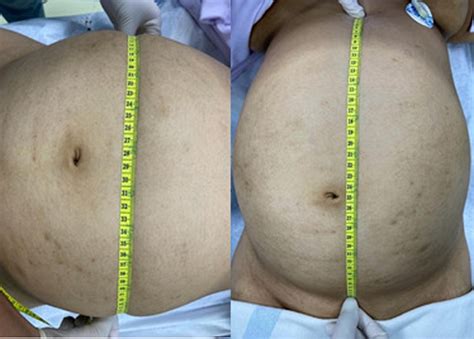 Measurement Of The Abdominal Mass During Physical Examination