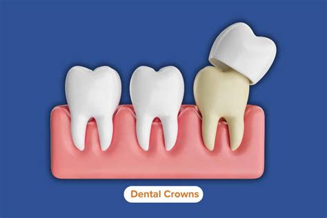 How Dental Crowns Protect And Strengthen Damaged Teeth