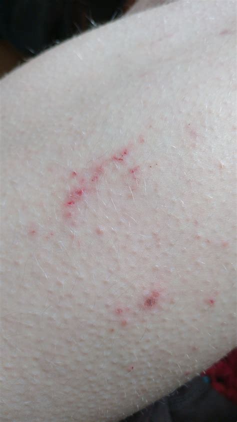 65 Weeks After Treatment Post Scabies Rscabies