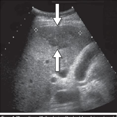 [pdf] Cryptogenic Pyogenic Liver Abscess Due To Fusobacterium Nucleatum A Case Report
