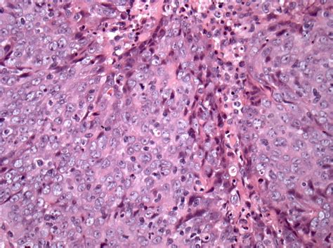 Nasopharyngeal Carcinoma Histology