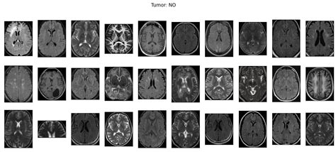 Github Seda Cpu Brain Tumor Diagnose Vgg16 Transfer Learning And Classification Of Brain
