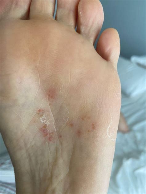 What Is This On My Moms Feet R Askdocs