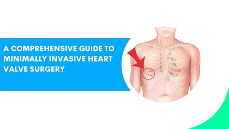 Minimally Invasive Bypass Surgery — Minimally Invasive Heart Surgery