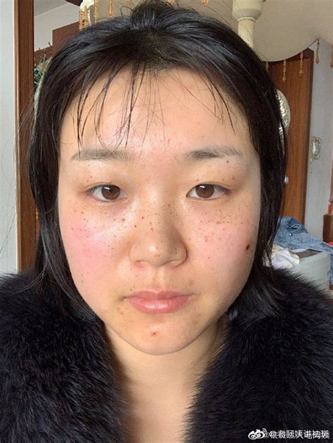 女性激光祛斑案例分享 来自小姐姐激光祛斑后的效果分享，希望能给你带来一些参考帮助 【色斑类型】：遗传性雀斑 【治疗方式】：光子嫩肤 【效果反馈】：十七天的时候结痂都掉完了，脸上也比之前看