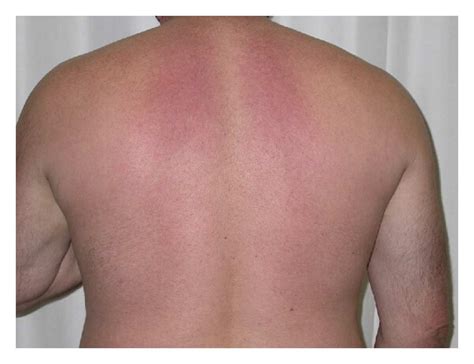 Scleredema Diabeticorum In A Patient With Type 2 Diabetes Mellitus