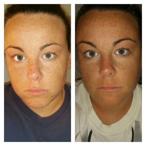 Epiduo Aczone Antibiotics Prescription Acne Medications