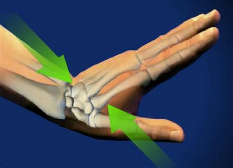 Fractura De Smith O Fractura De Colles Reversa Causas Síntomas