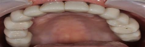 Maxillary Bridge Prosthesis Download Scientific Diagram