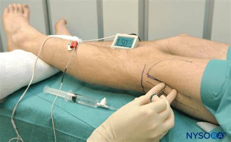 Popliteal Sciatic Nerve Blocks Intertendinous Lateral