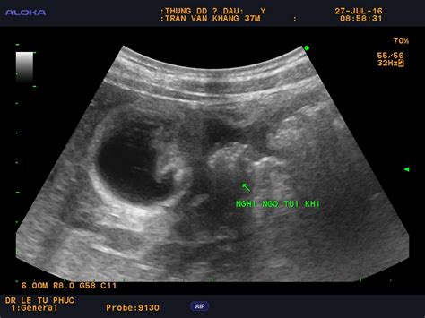 Vietnamese Medic Ultrasound Case 392 Perforated Seal Off Duodenum Dr
